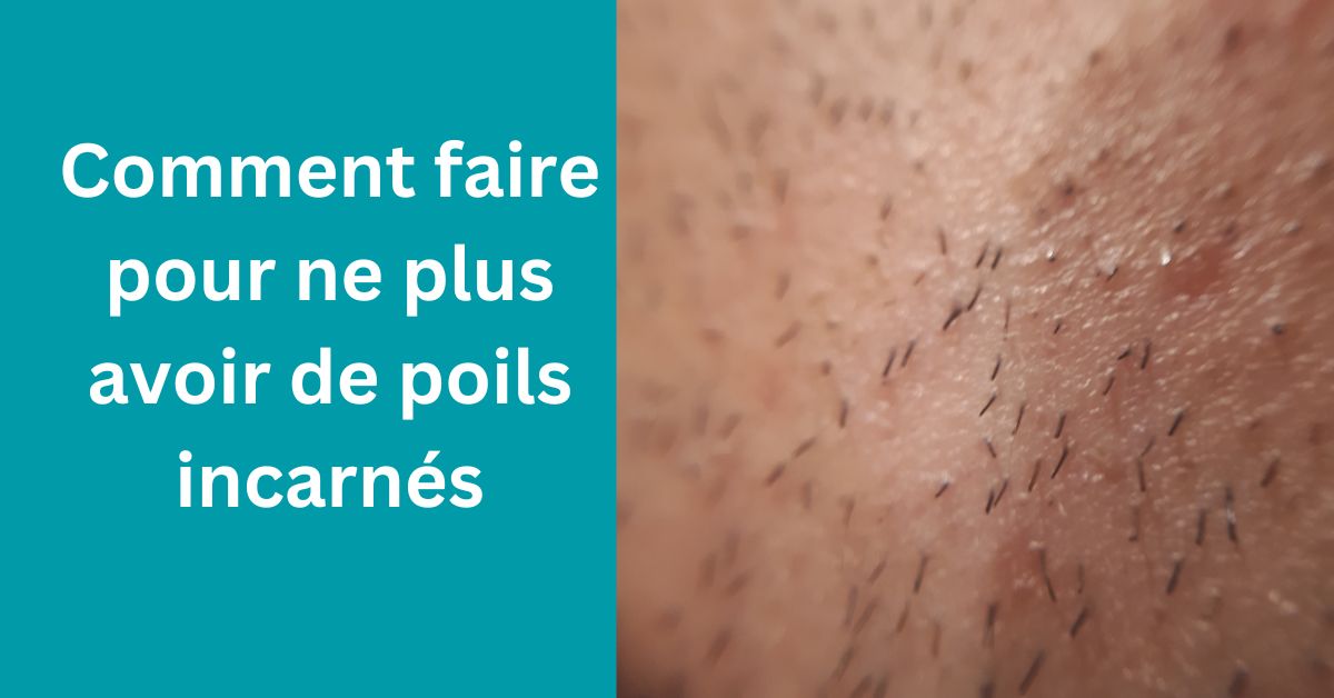 Comment Faire Pour Ne Plus Avoir De Poils Incarnés : Astuces Simples Et ...